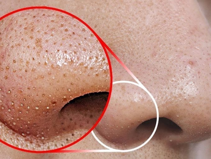 This Super Easy 2 Ingredient Recipe Will Eliminate Your Nail Fungus Forever